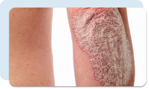 Skin Diseases: A Comprehensive List with Pictures - Dermacare by Docandu